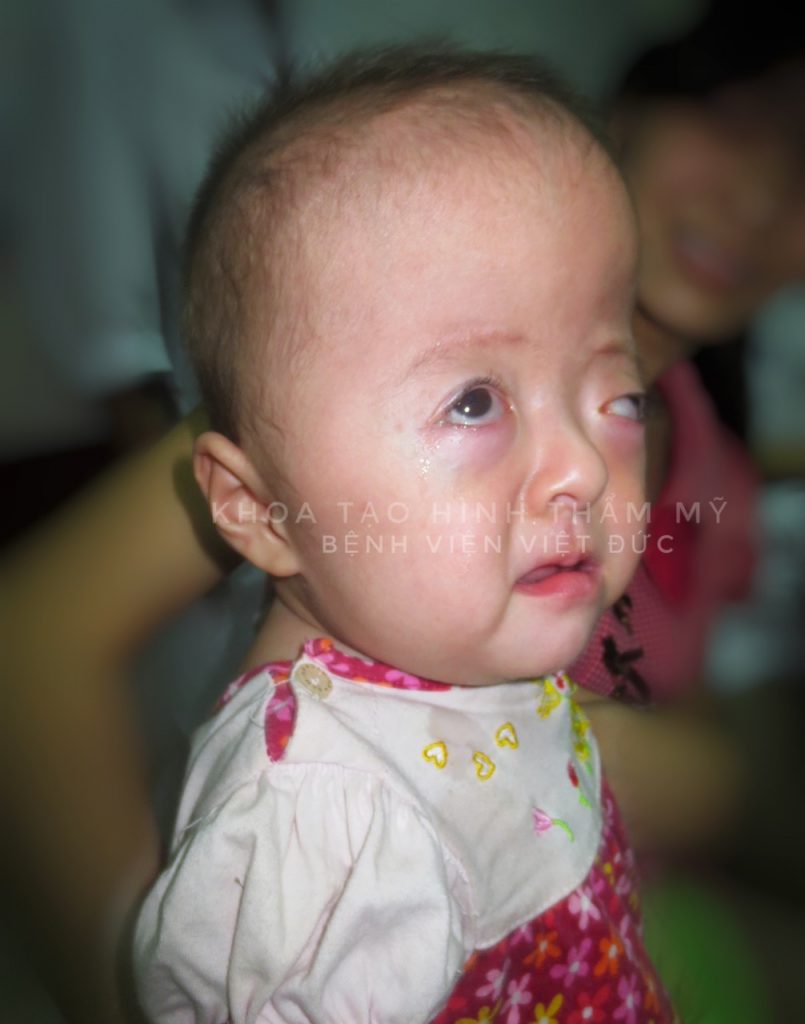 Successful treatment of complex narrow-skull syndrome (Apert’s Syndrome ...