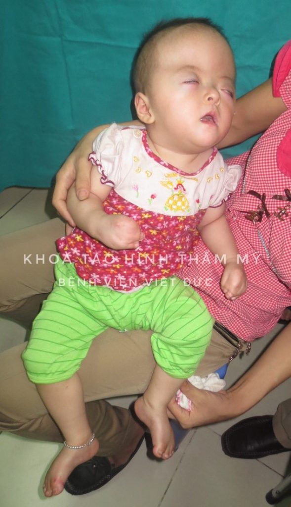 Successful treatment of complex narrow-skull syndrome (Apert’s Syndrome ...